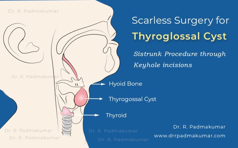 Thyroglossal Cyst Excision | Endoscopic - Dr. R. Padmakumar