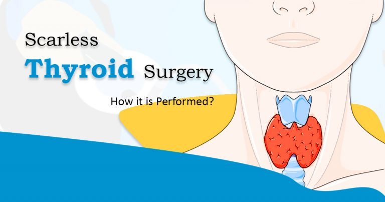 Endoscopic Thyroidectomy - Scarless Thyroid Surgery