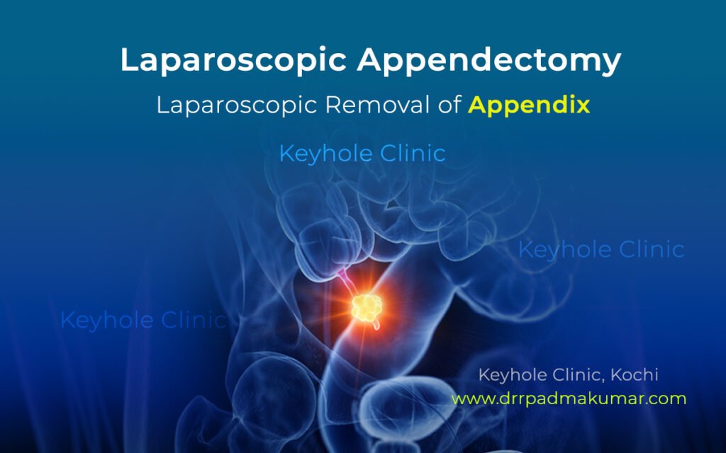 Laparoscopic Appendectomy - Lap Removal of Appendix in Kochi