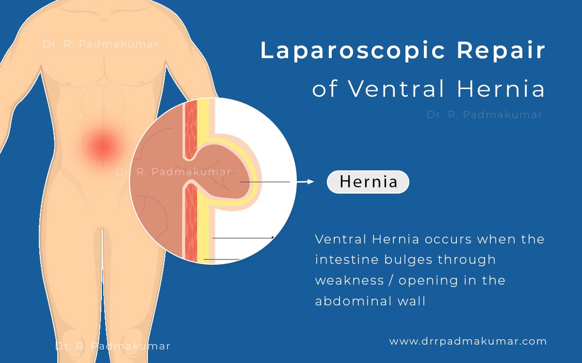 Ventral Hernia Icd 10 Reporting Hernia Repair And Abdominal Wall