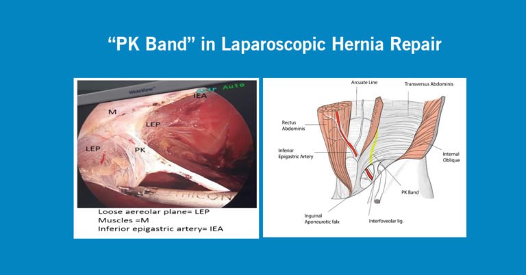 “PK Band” in Laparoscopic Hernia Repair - Dr. R. Padmakumar
