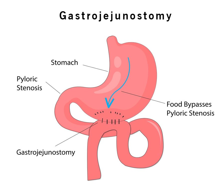 Duodenojejunostomy Bypass Cpt Duodenojejunostomy Bypass Cpt