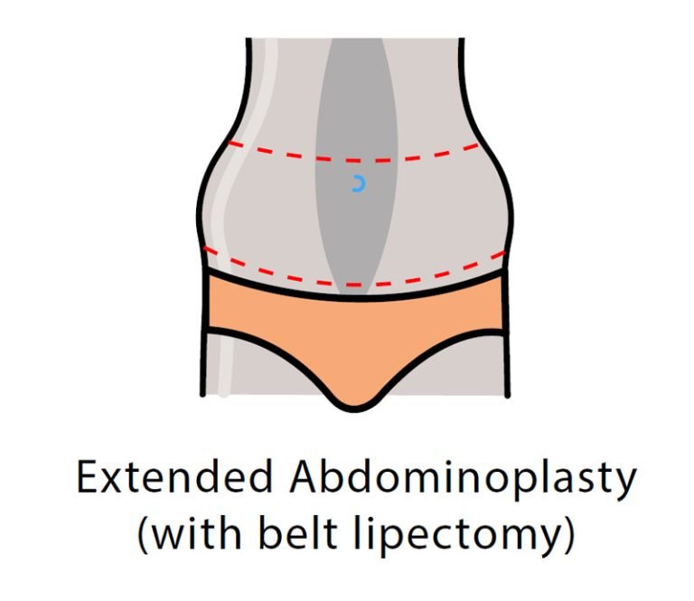 Tummy Tuck Surgery in Kerala, India | Abdominoplasty