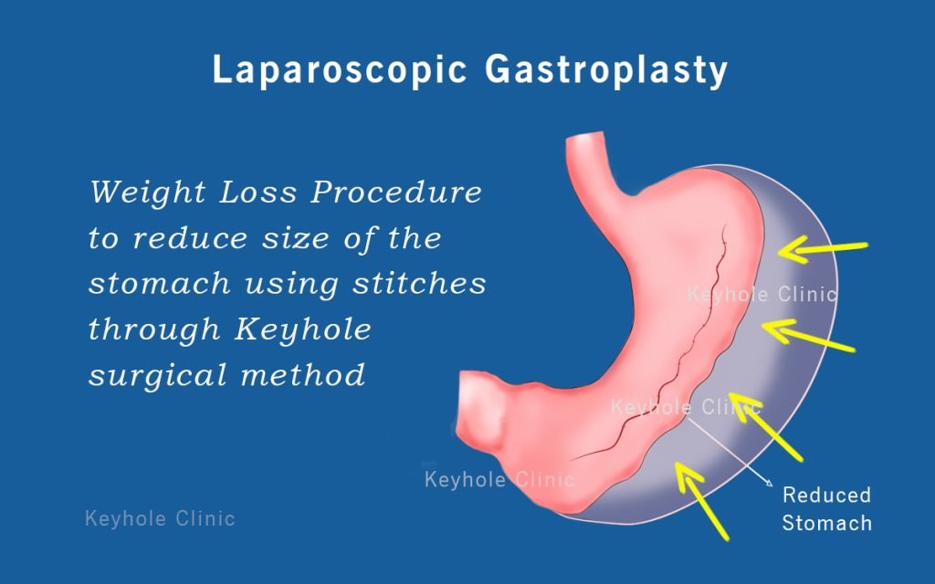 Laparoscopic Gastroplasty - Dr. R. Padmakumar